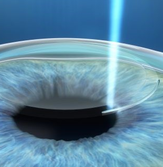 SMILE Pro: Transform Your Vision with Advanced Smile LASIK Technology