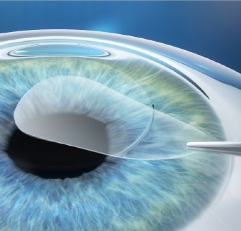 SMILE Pro: Transform Your Vision with Advanced Smile LASIK Technology