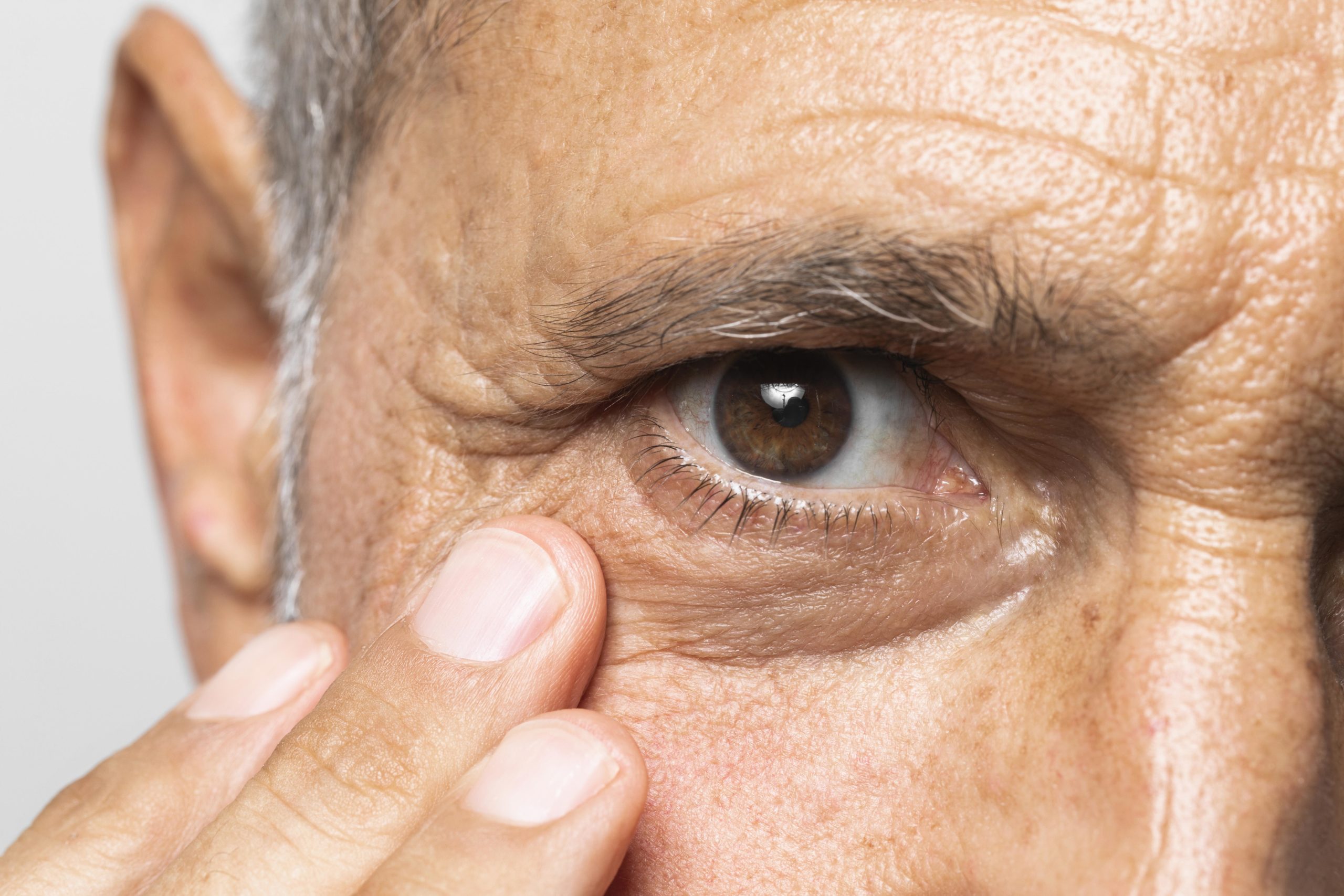 Trabeculectomy: Relieving Pressure & Managing Glaucoma