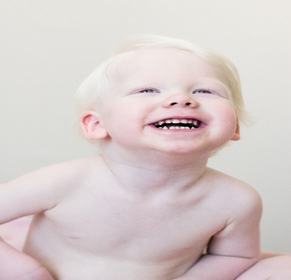 What Is Nystagmus And What Causes It What Is Nystagmus And What Causes It