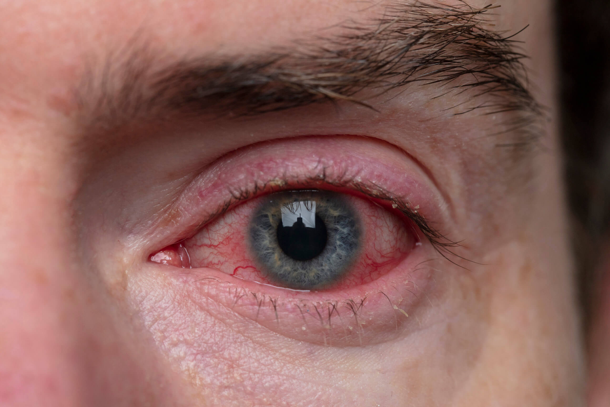 Understanding Corneal Eye Ulcers: Causes, Symptoms, and Treatment