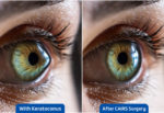 CAIRS Eye Surgery - CAIRS Treatment for Keratoconus