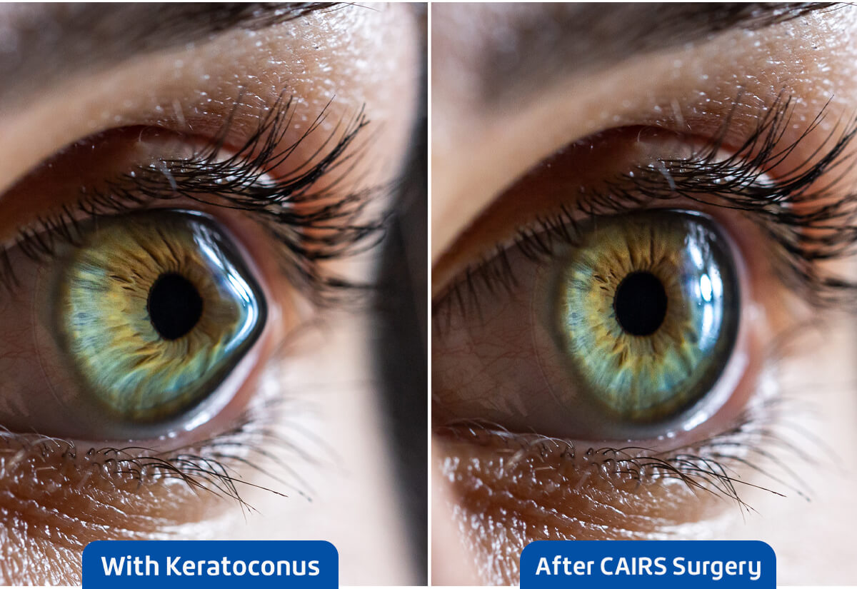CAIRS Eye Surgery - CAIRS Treatment for Keratoconus