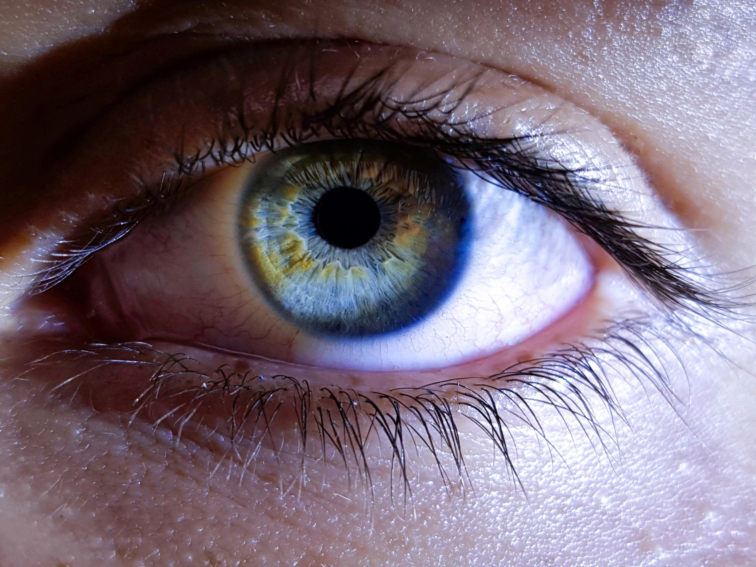 Type of Conjunctivitis (Pink Eye): Common Symptoms and Treatment