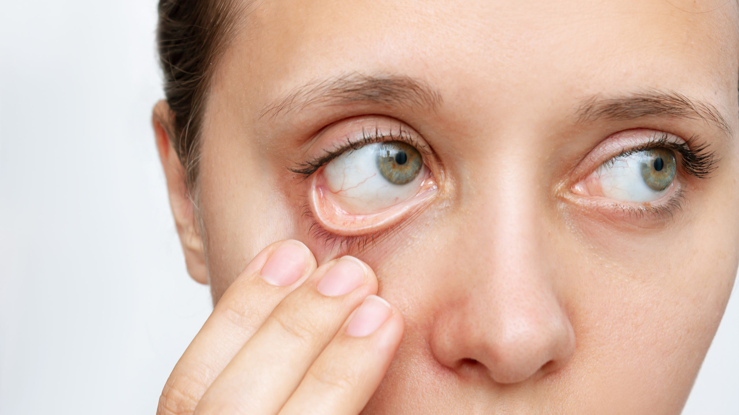 How Dry Eye Syndrome Impacts Mental Health