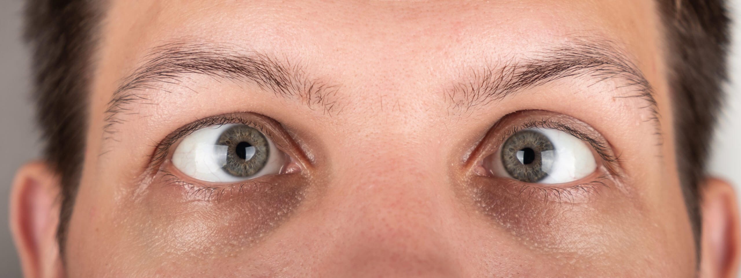 Exotropia Treatment: Meaning, Glasses and Surgery Options.